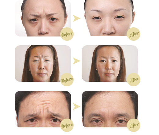 ボトックス注射｜豊橋の美容皮膚科 遠山クリニック